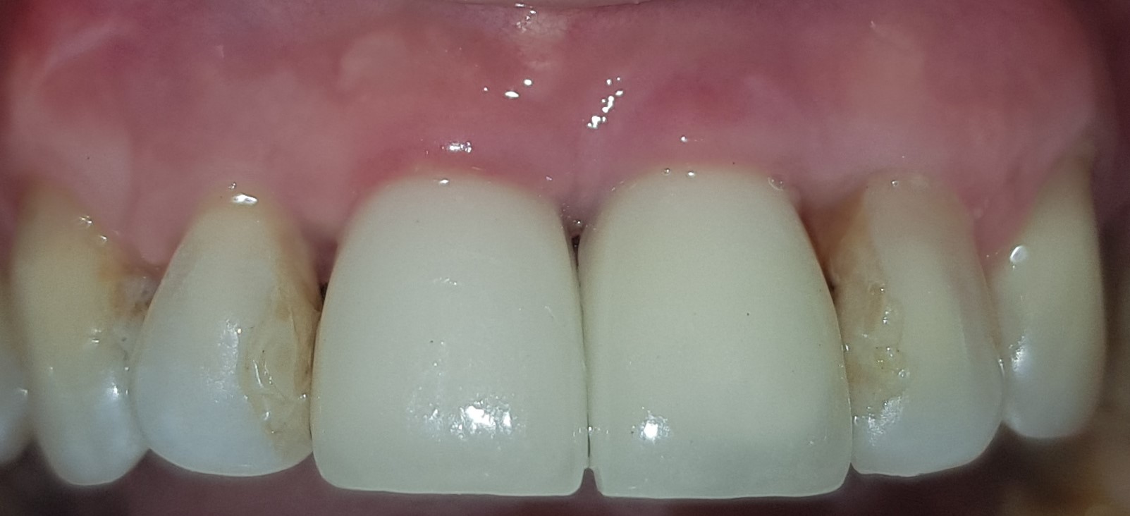 Implantes y cubrimiento de recesiones gingivales - Dr.Raúl Caffo Suárez