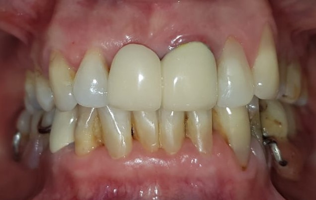 Implantes y cubrimiento de recesiones gingivales - Dr.Raúl Caffo Suárez